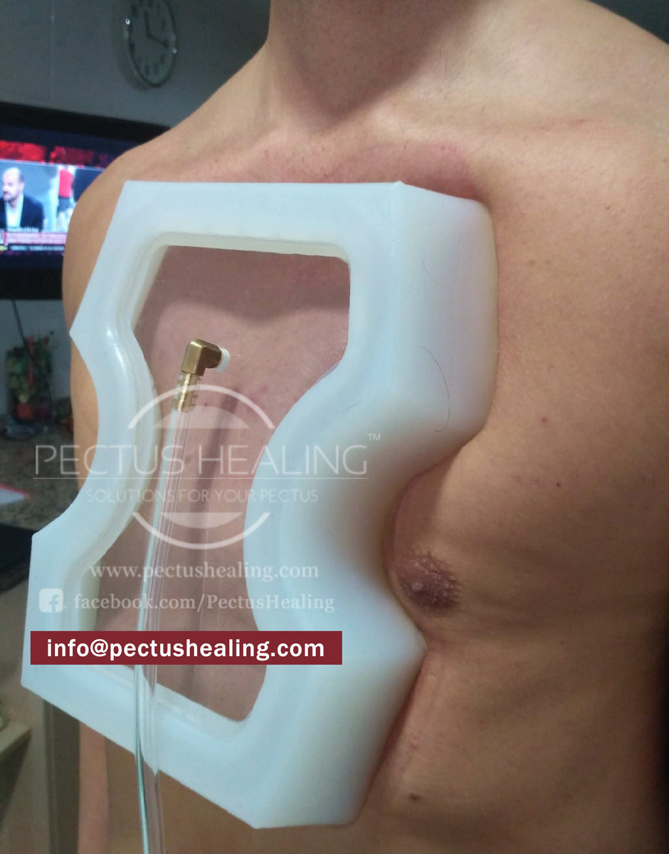 Vacuum Bell 26x21 cm – Wide Pectus Excavatum Device | PECTUS ...